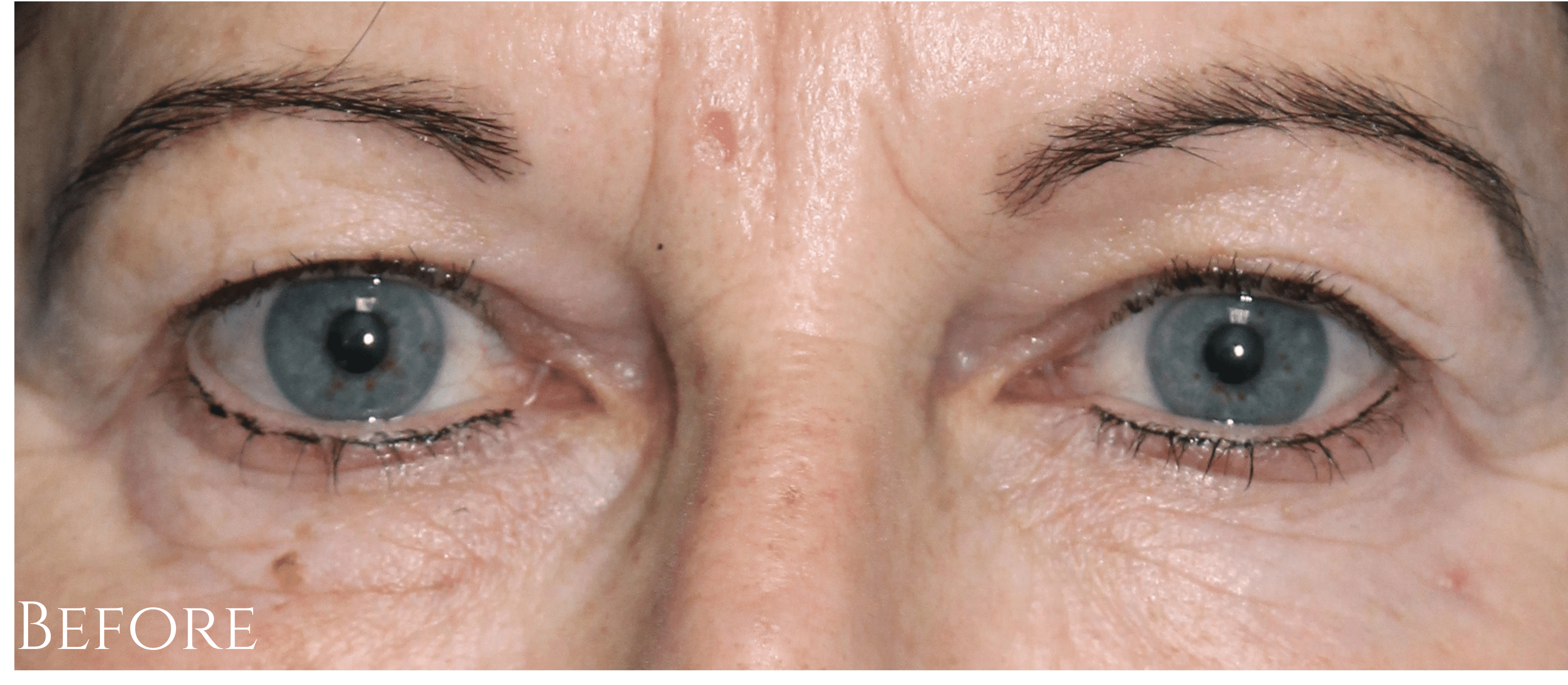 Blepharoplasty: Eyelid Surgery - Skin Centre