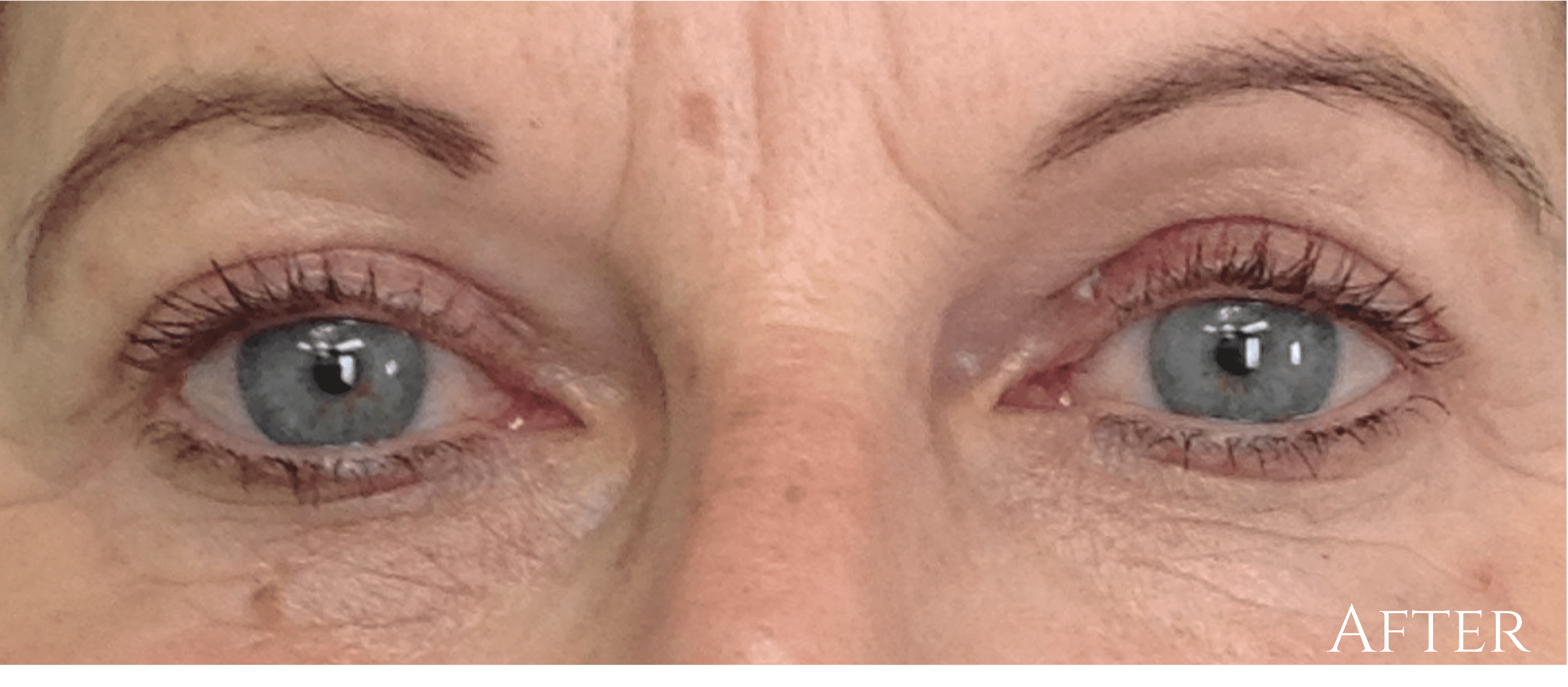 Blepharoplasty: Eyelid Surgery - Skin Centre